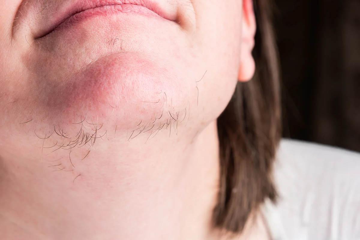 هیرسوتیسم چیست و چه درمان هایی برای آن موثر است؟ - دکترنکست